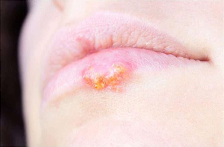 ¿Qué es el Herpes Labial?